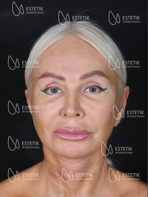 Total Face Rejuvenation